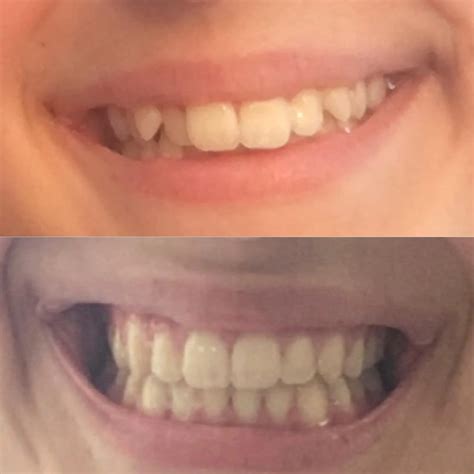 Before After Braces 20 Months Scrolller