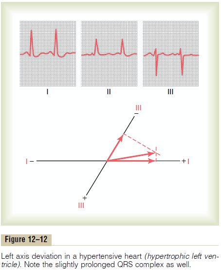 Mean Electrical Axis Of The Ventricular Qrs And Its Significance