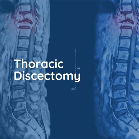 Vertebrectomy Corpectomy