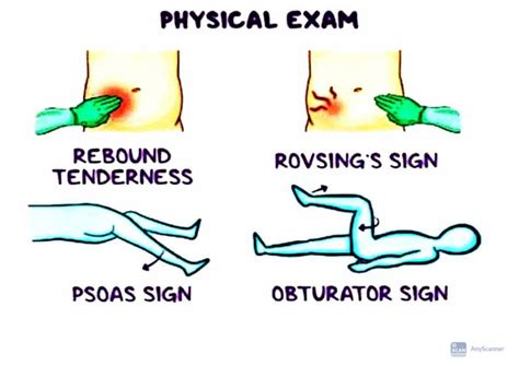 Appendicitis Sign Trick Pdf
