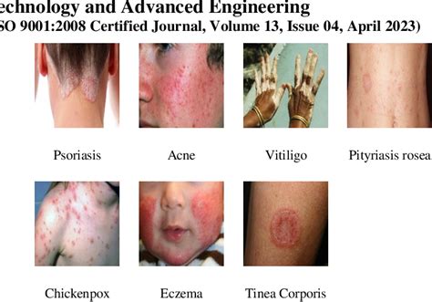Figure 1 From Classification Of Skin Disease Using Transfer Learning In