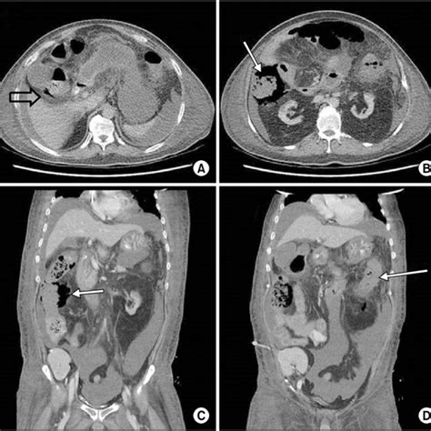 Endoscopic Findings Consistent With Ischemic Colitis Download