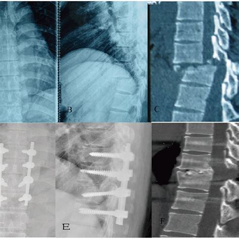 Pdf Transforaminal Decompression And Interbody Fusion In The