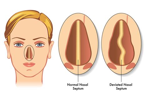 Deviated Septum Symptoms And Treatments University Health News