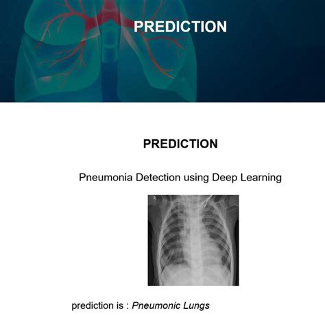 JPPY Pneumonia Detection Using Deep Learning JP INFOTECH