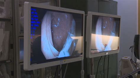 Ai Tool For Colonoscopies Helps Detect Polyps That Can Become Cancerous