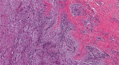 Nodular Fasciitis Archives Ottawa Atlas Of Pathology