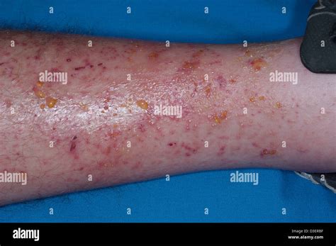 Poison Sumac Rash On Leg