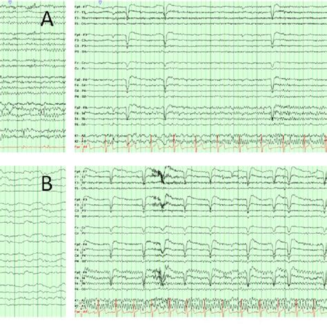 Examples Of EEG Abnormalities A Focal Right Temporal Slowing Maximal Download Scientific