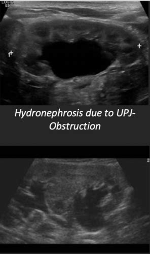 Pediatrics 1 Pediatric Uti Flashcards Quizlet