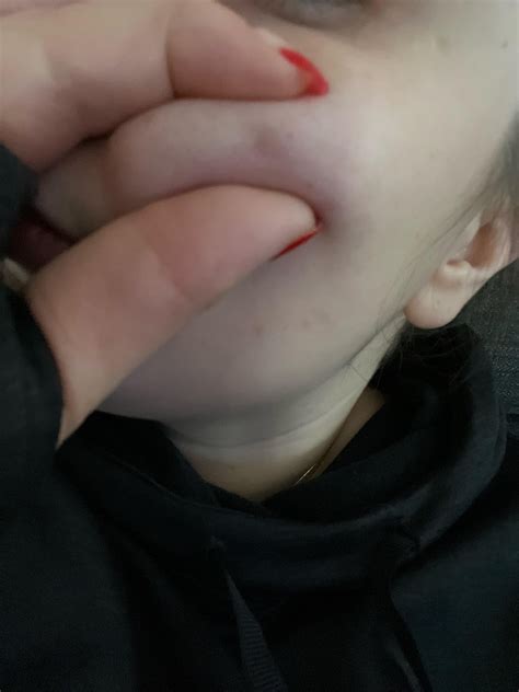 Pimple Under The Skin Or Something Else R Canskincare