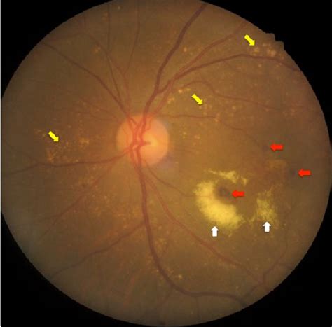 Figure 1 From Idiopathic Polypoidal Choroidal Vasculopathy In Thai