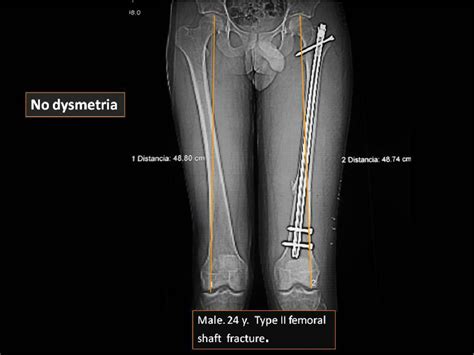Figure 3 From Femoral Shaft Fractures Malalignment After Intramedullary Nailing Semantic Scholar