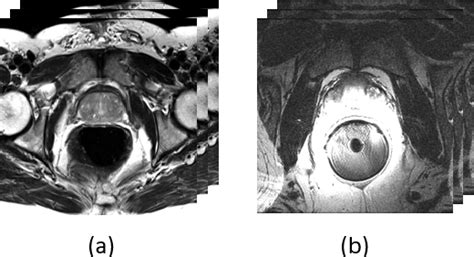 Figure 1 From Automatic Prostate Segmentation On 3d Mri Scans Using