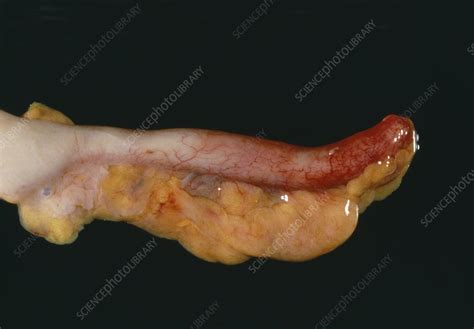 Appendix Infection