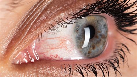 Uveitis Symptoms Causes And Treatment Options Explained