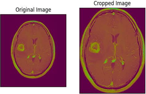 Enhancing Brain Tumor Mri Classification With An Ensemble Of Deep Learning Models And