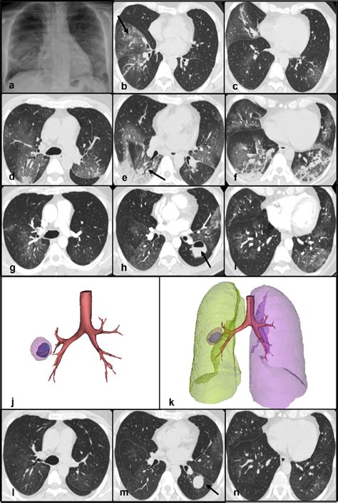 Panel A Frontal Chest X Ray Demonstrating Subtle Bilateral Opacities