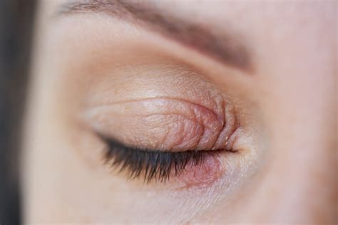 Say Goodbye To Itchy Irritated Eyes A Guide To Managing Blepharitis Vue Optometry