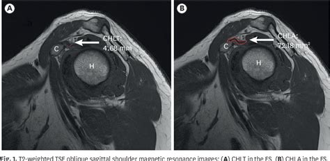 Coracohumeral Ligament Mri