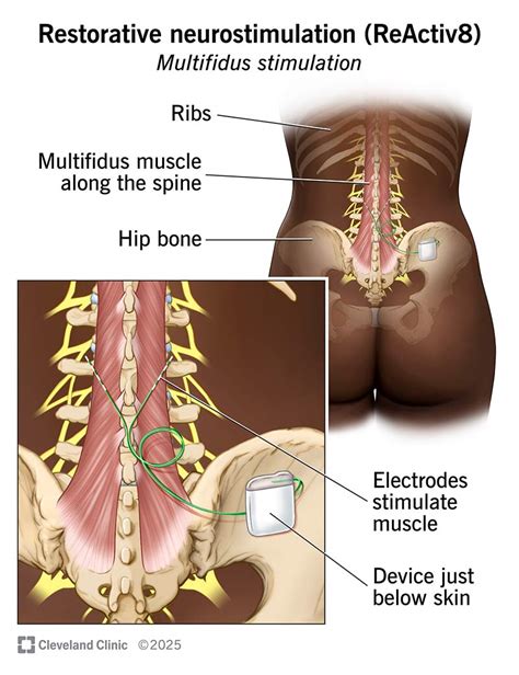 Multifidus Muscle Pain