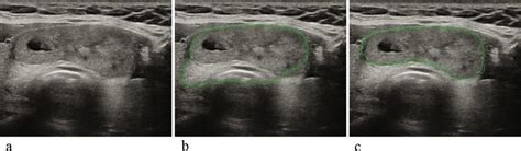 Example Of Roi Correction Using Semiautomatic Segmentation By The First Download Scientific