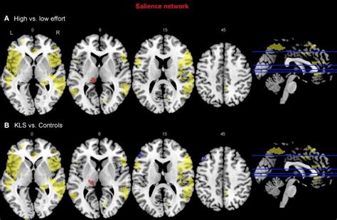 Functional Connectivity In The Salience Network The Images Show The