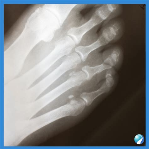 Proximal Phalanx Fracture Of The Foot Comprehensive Guide For Patients