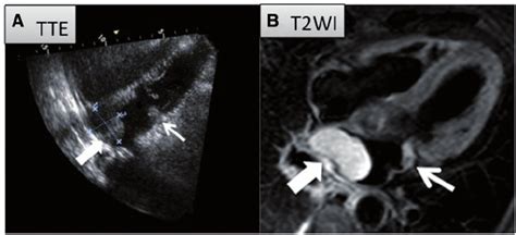 Imaging Of The Intimal Sarcoma Involving The Left Atrium And Mitral Download Scientific Diagram