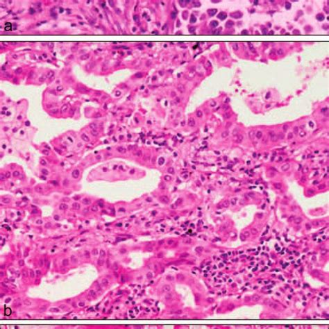 Histologic Features Of The Micropapillary Pattern In Pulmonary Download Scientific Diagram