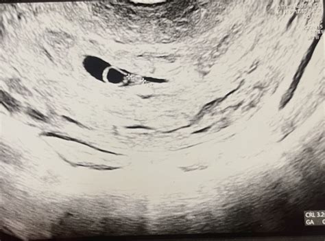 Bubble In Scan Mumsnet