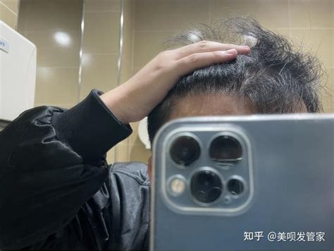 真实植发全分享，必收藏！植发，我真的很后悔！ 知乎