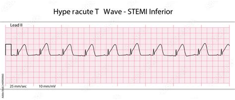 Ecg Hyperacute Stemi 8 Second Ecg Paper Peaked T Wave Vectors And Illustrations For