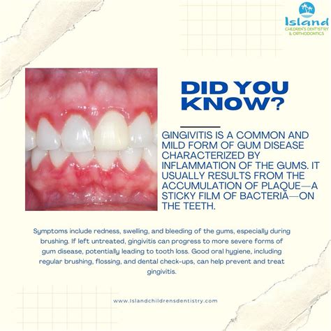 Island Did You Know Gingivitis Is The Early Stage Of Gum Disease