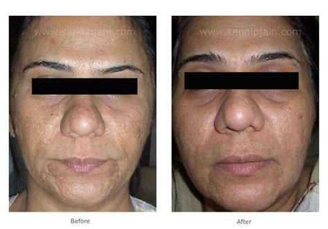 45 Year Old Female With Post Acne Pitted Scars On The Cheekschin