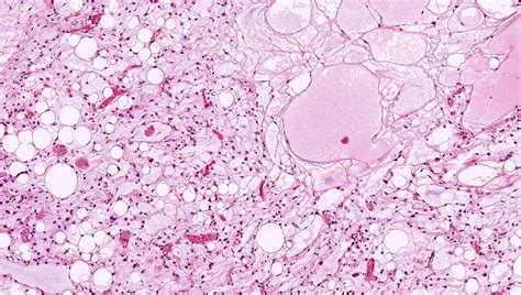 Dedifferentiated Liposarcoma Pathology