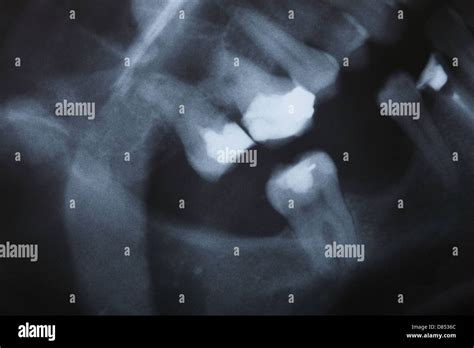 Detail X Ray Image Scan Of Humans Teeth Stock Photo Alamy