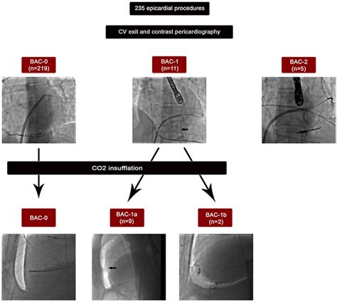 Assessment Of Pericardial Adhesions By Means Of The Epico2 Technique