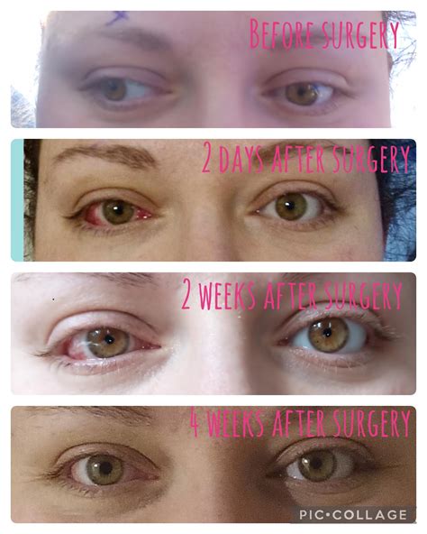 215 Best R Strabismus Images On Pholder Had Strabismus Surgery