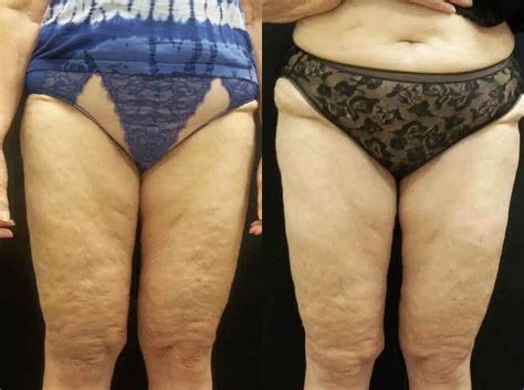 Cellulite Reduction Before And After Photos In Franklin