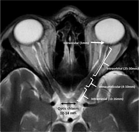 Optic Nerve Imaging In Multiple Sclerosis And Related Disorders