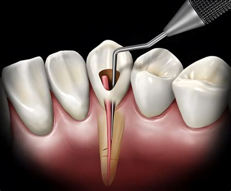 Tratamiento De Conducto Radicular Dr Carlos Lara