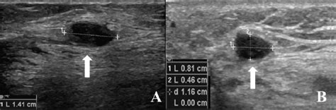 Laser Thermal Ablation To Treat A Recurrent Soft Tissue Sarcoma Of The