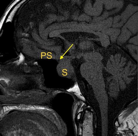 Preoperative Approach To Sellar Region Masses What The Surgeon Needs To Know At Least What I