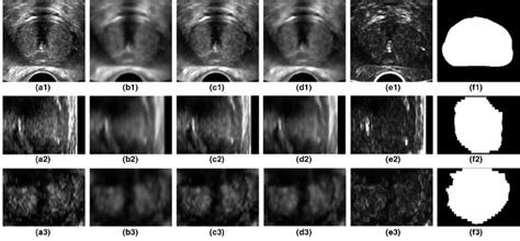 The Multiderivative Images And The Corresponding Prostate A1 A3 Trus