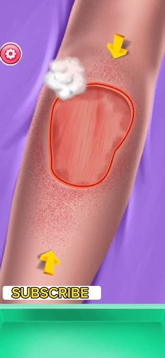 Surgery Animation C Section Shorts Diy Emotekill Viral