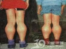 鸭步步态鸭步步态的起因 诊断 检查 鉴别 治疗 症状查询 39疾病百科