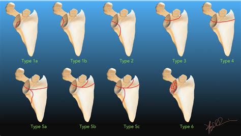 Scapula Fracture Types Radiology At Darla Adkins Blog Scapula Fracture Types Radiology At Darla Adkins Blog