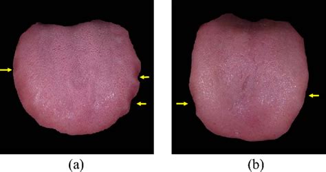 figure 4 from tooth marked tongue recognition using multiple instance