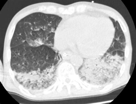 Hypercalcemic Crisis Resulting From Near Drowning In An Indoor Public